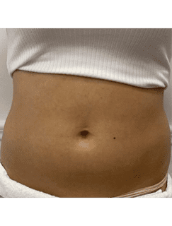 CoolShaping2 | Fat Freezing Machine